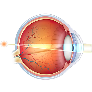 LASIK Los Angeles, CA - Los Angeles Vision Institute