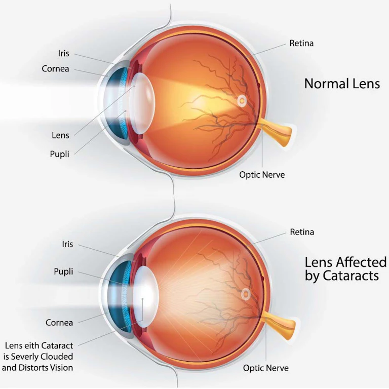 Cataract Surgery Merrillville, IN - Hobart, IN - Deen-Gross Eye Centers