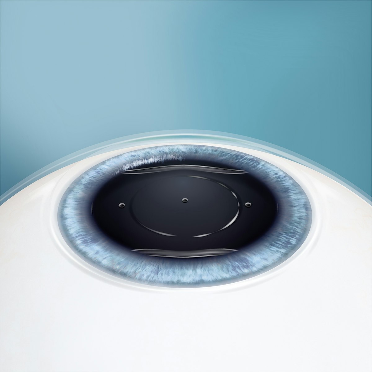 EVO ICL Dallas - Fort Worth - Plano - Implantable Collamer Lens ...