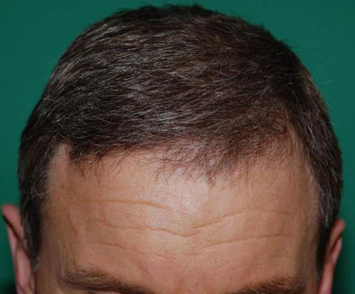 Hair Transplant Chicago, IL - Chicago Hair Institute