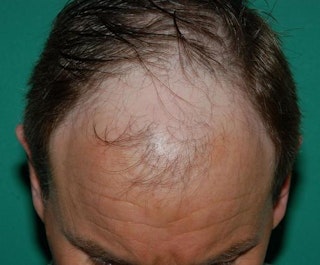 Hair Transplant Chicago, IL - Chicago Hair Institute