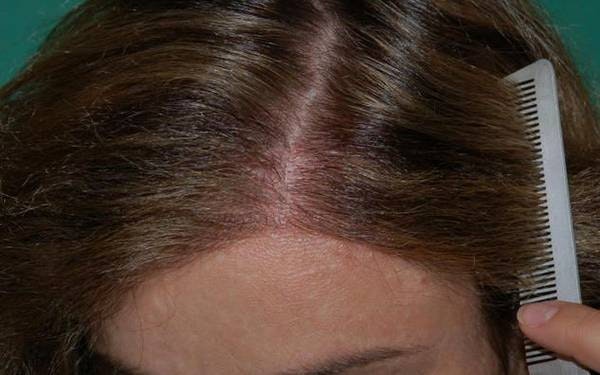 Hair Transplant Chicago, IL - Chicago Hair Institute