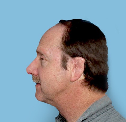 Microtia Surgeon Beverly Hills, CA - Reinisch Plastic Surgery