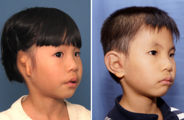 Microtia Treatment Beverly Hills, CA - Reinisch Plastic Surgery