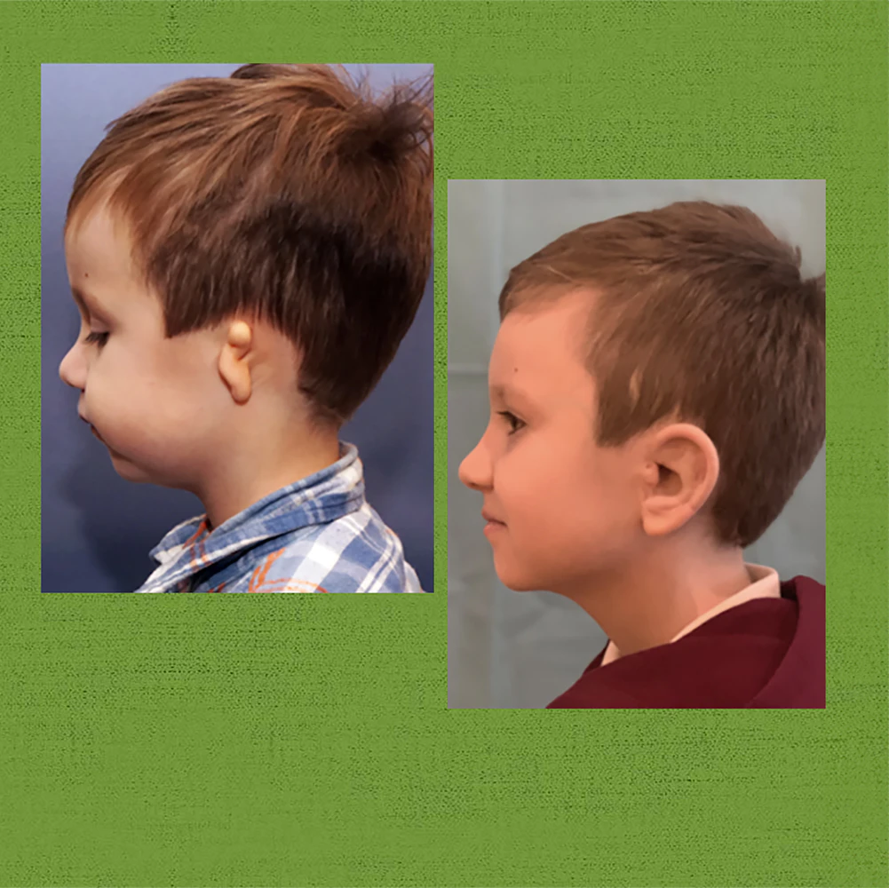 Microtia Treatment Beverly Hills, CA - Reinisch Plastic Surgery