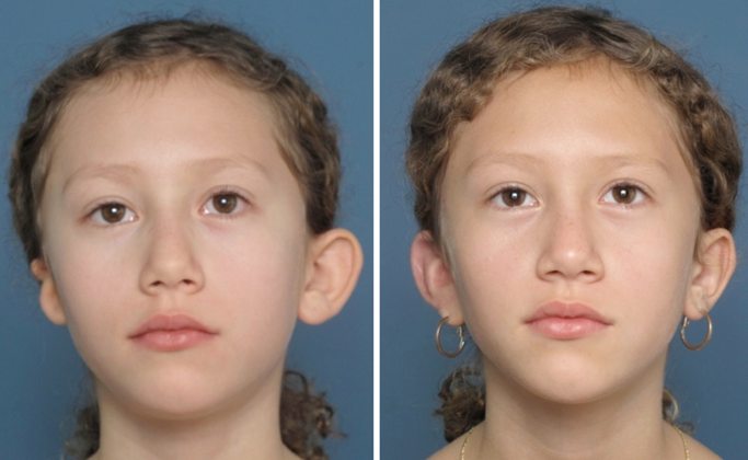 Pediatric Ear Reconstruction Beverly Hills, CA - Reinisch Plastic Surgery