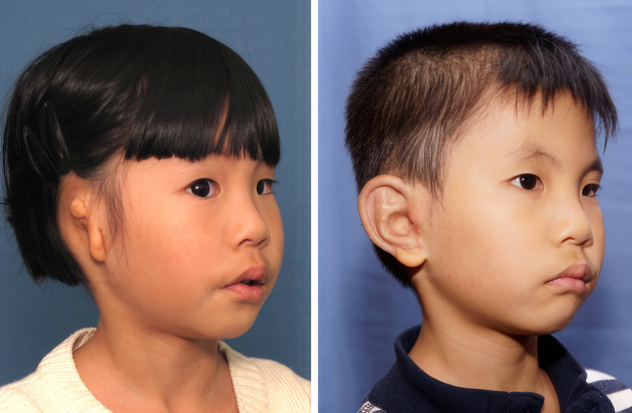 Microtia Treatment in Beverly Hills, CA | Reinisch Plastic Surgery