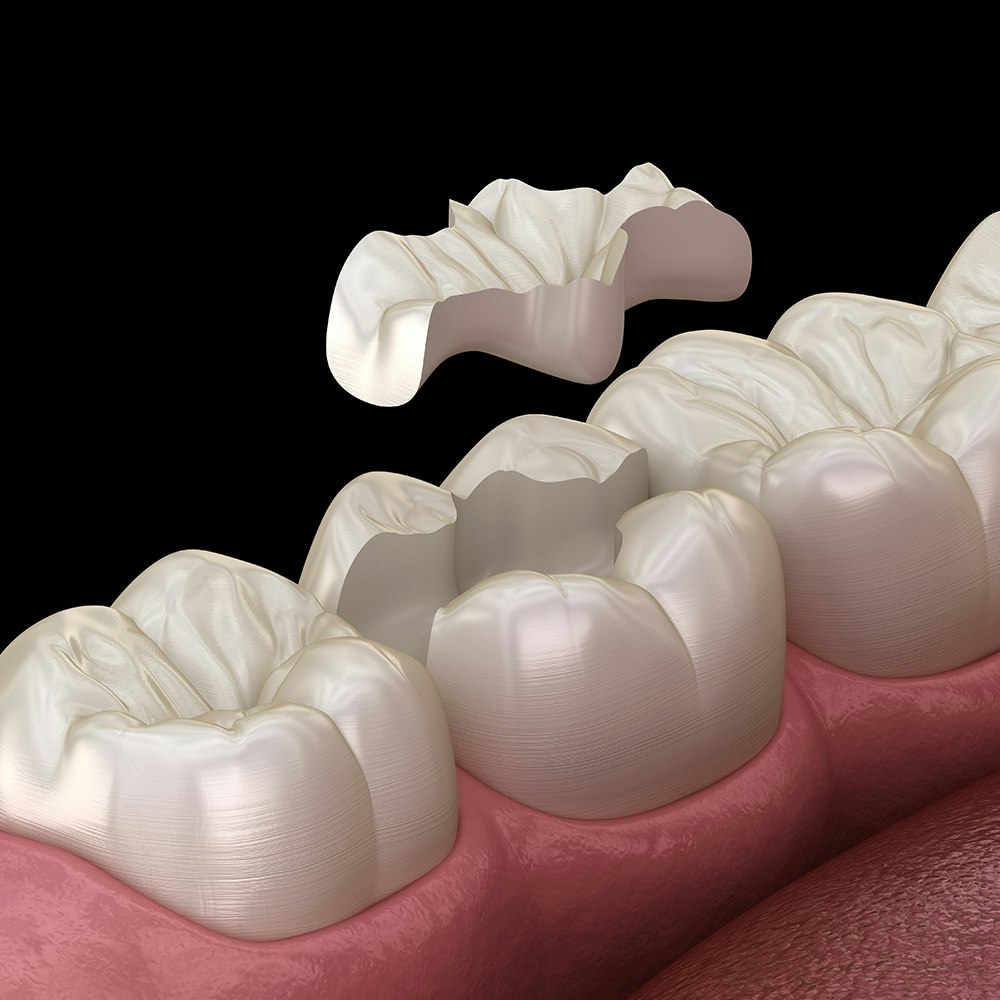 Inlays and Onlays New Jersey - NUVA Smile