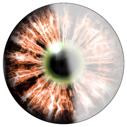 Rizzuti Sign Keratoconus