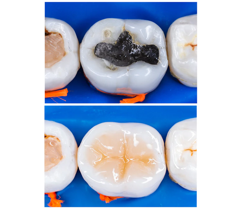 Fillings Fort Wayne, IN - Tooth Filling - Harrison Dental Group