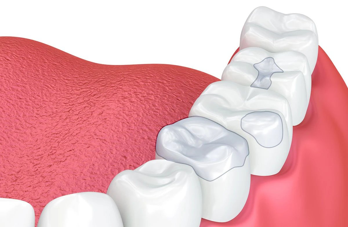 All-Ceramic Restorations Loveland, CO - West Lake Dental