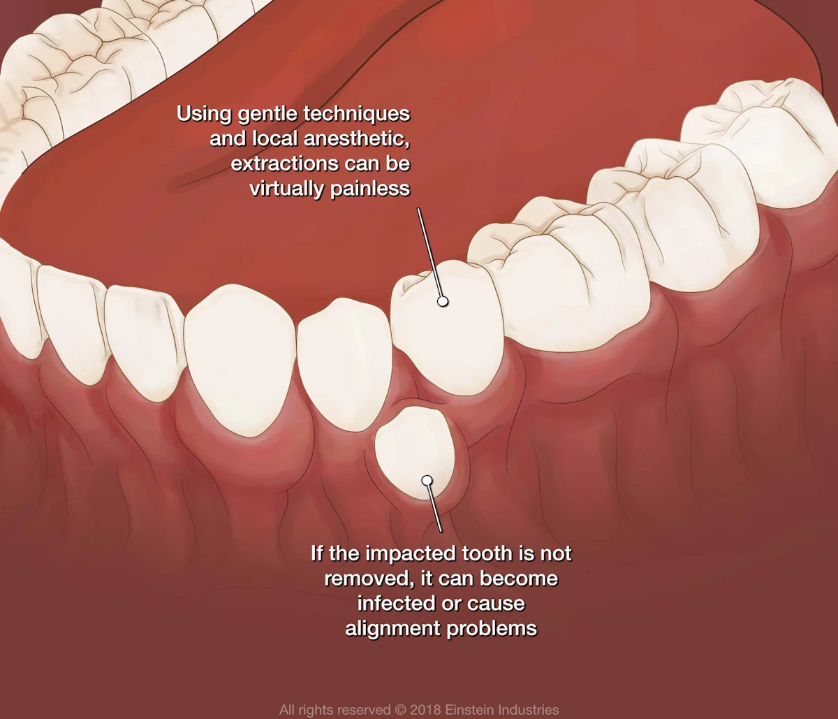 Tooth Extraction Logan, UT - Garland, UT - Gregory E. Anderson PC