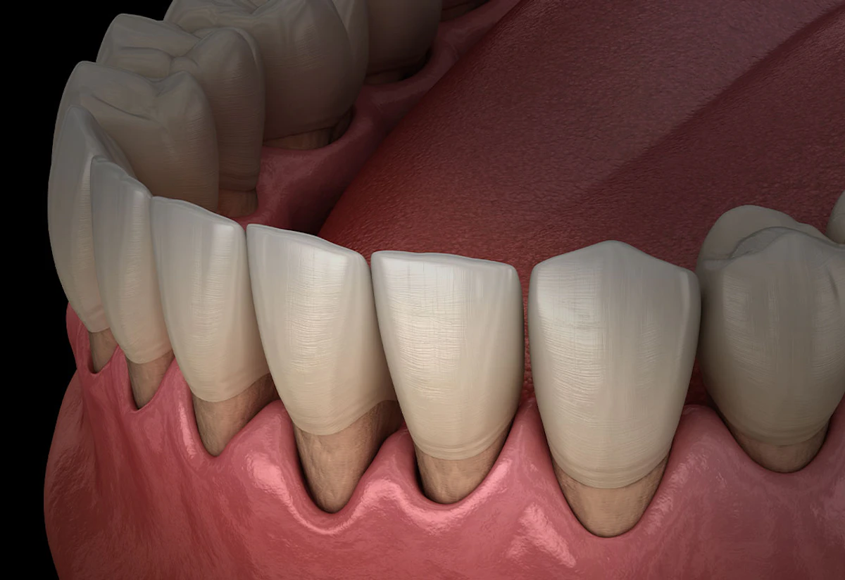 Gum Graft - Nutley, NJ - MK Periodontics & Implant Dentistry P.C.