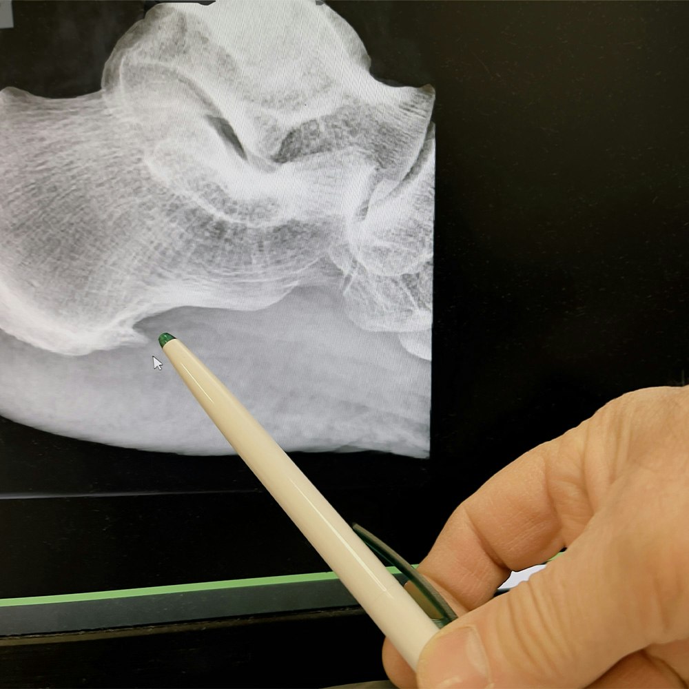 Plantar Fasciitis Hartford County, CT - Advanced Foot & Ankle Specialists