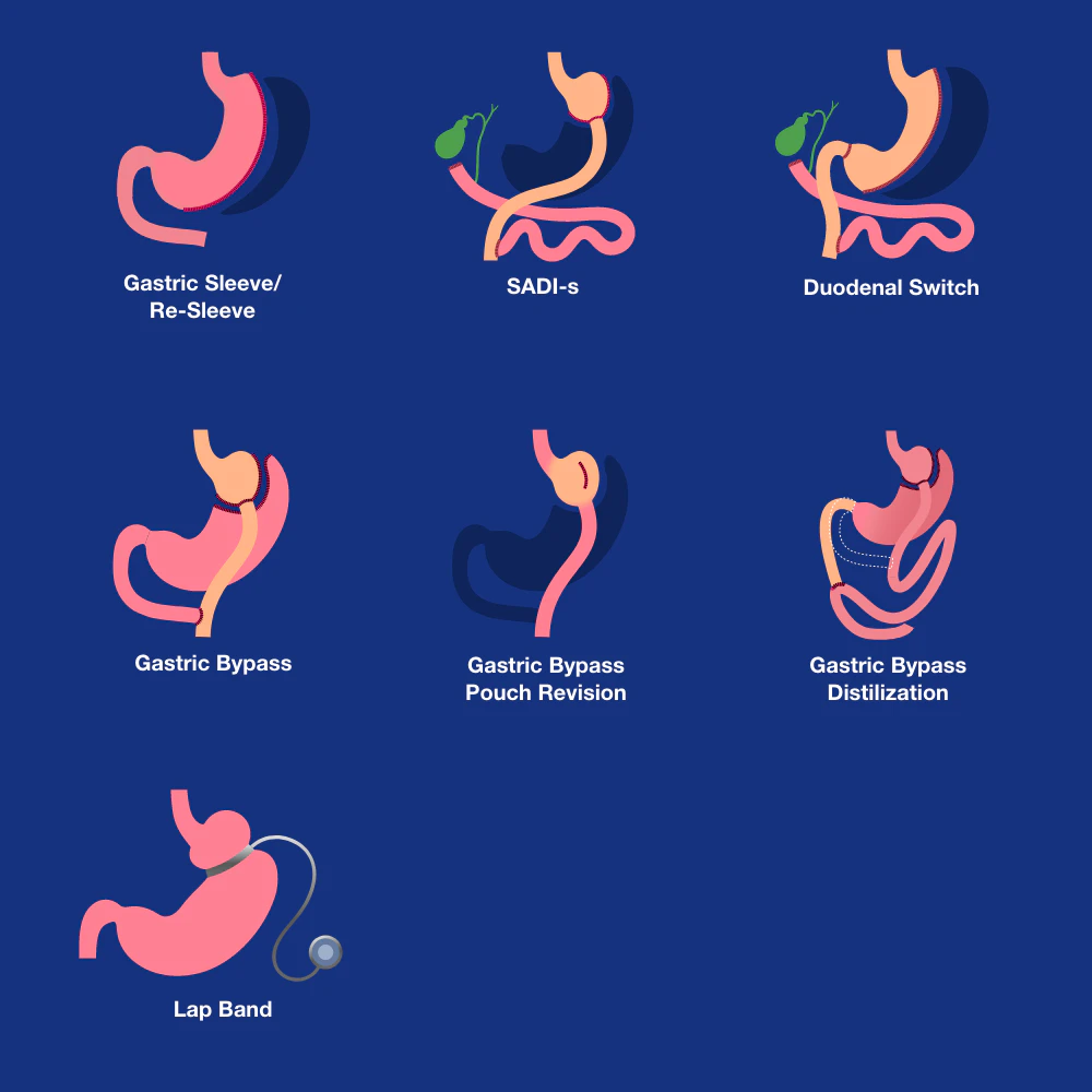 Bariatric Revision Surgery Plano, TX - Texas Center for Bariatrics ...