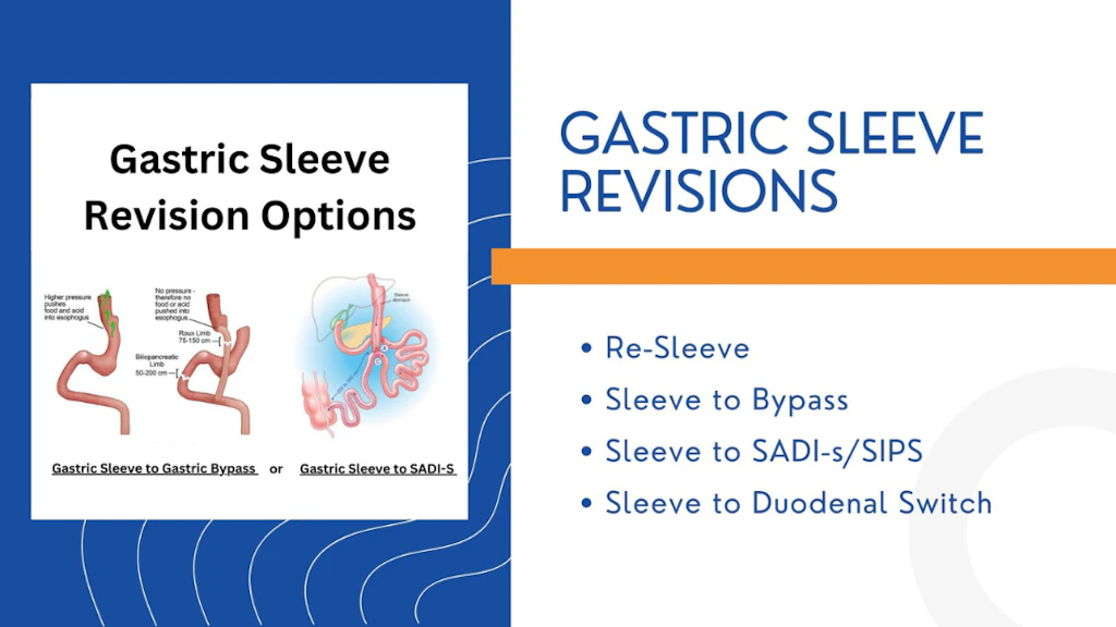 Bariatric Revision Surgery in Plano, TX | Texas Center for Bariatrics ...