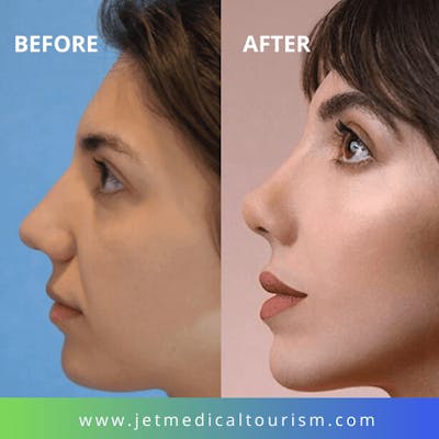 Rhinoplasty Surgery in Mexico | Nose Job Cost Mexico
