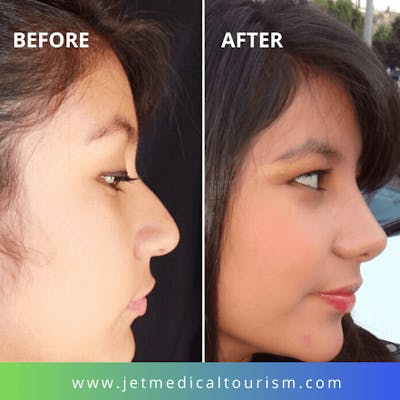 Rhinoplasty Surgery in Mexico | Nose Job Cost Mexico