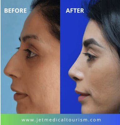 Rhinoplasty Surgery in Mexico | Nose Job Cost Mexico