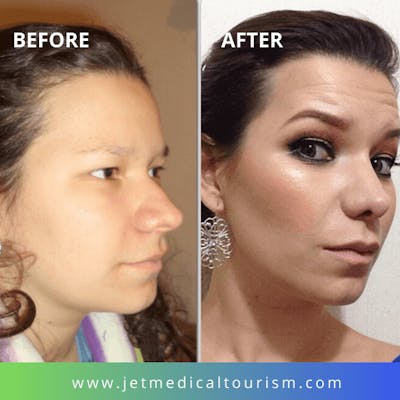 Rhinoplasty Surgery in Mexico | Nose Job Cost Mexico