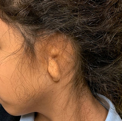 Microtia: Causes & Treatment