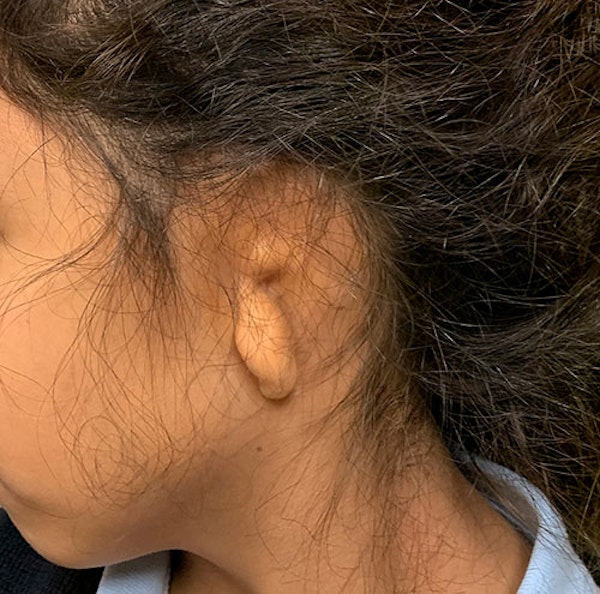 Microtia: Causes & Treatment