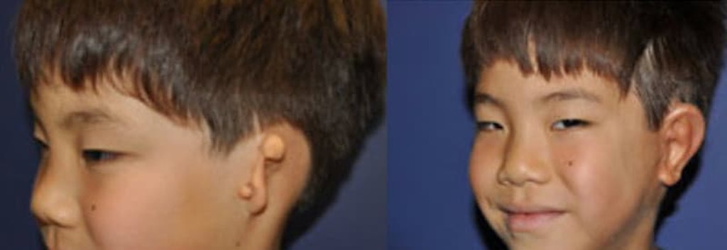 Microtia Surgery - Before and After Microtia Surgery Photos | Dr. Bonilla
