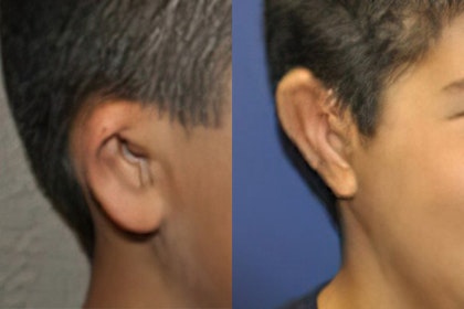 Dr. Bonilla Microtia - Congenital Ear Institute