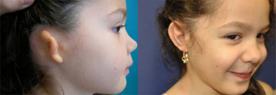 Microtia Treatment Options - Cartilage or Polyethylene Implant | Dr ...