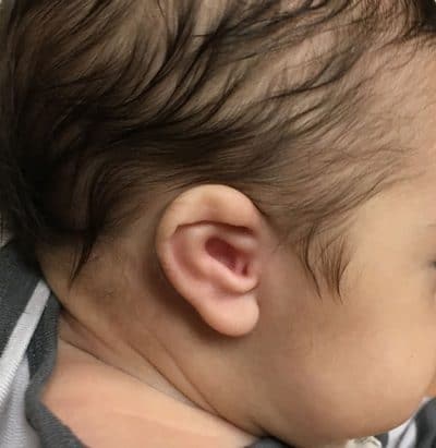 Microtia - Congenital Ear Institute