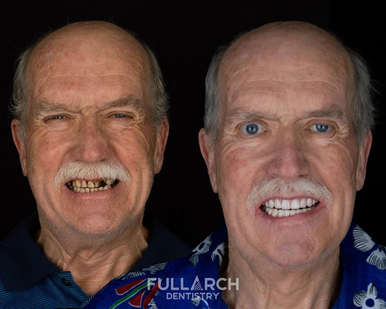 Implantologist Los Algodones Baja California - Periodontics - Full arch ...