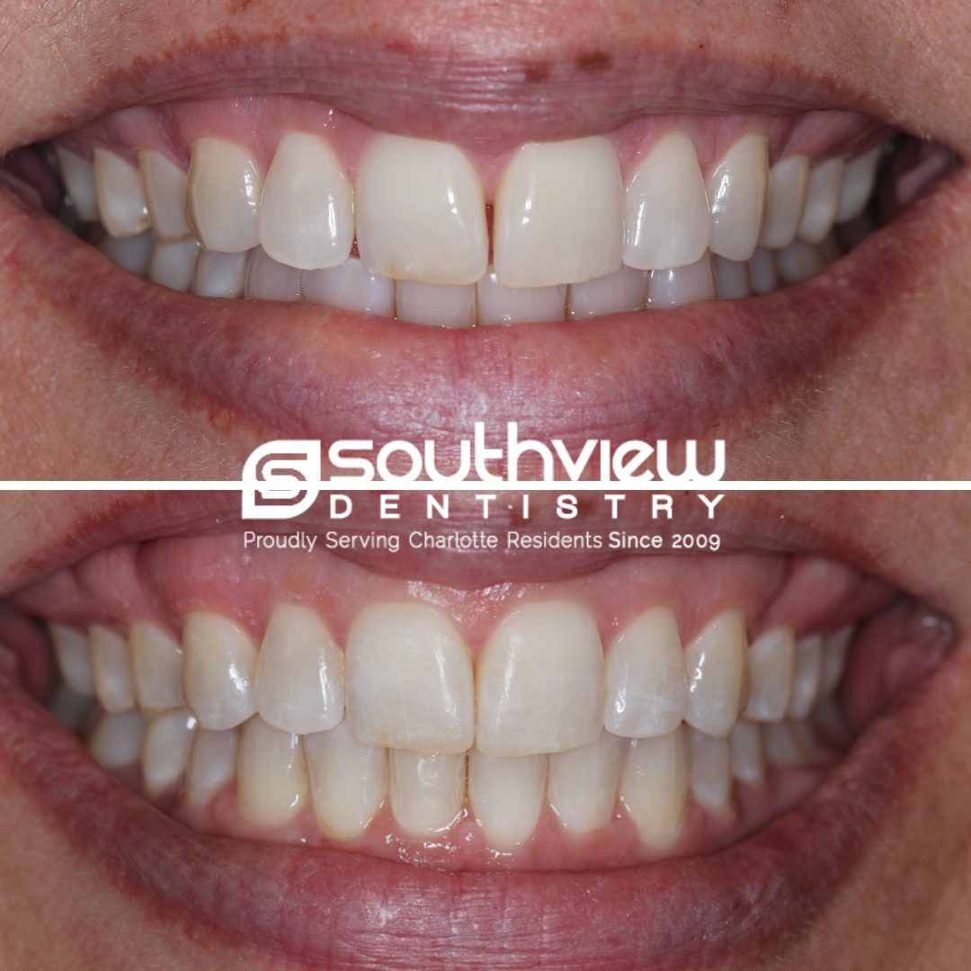 Invisalign Charlotte, NC - Clear Aligners - SouthView Cosmetic Dentistry